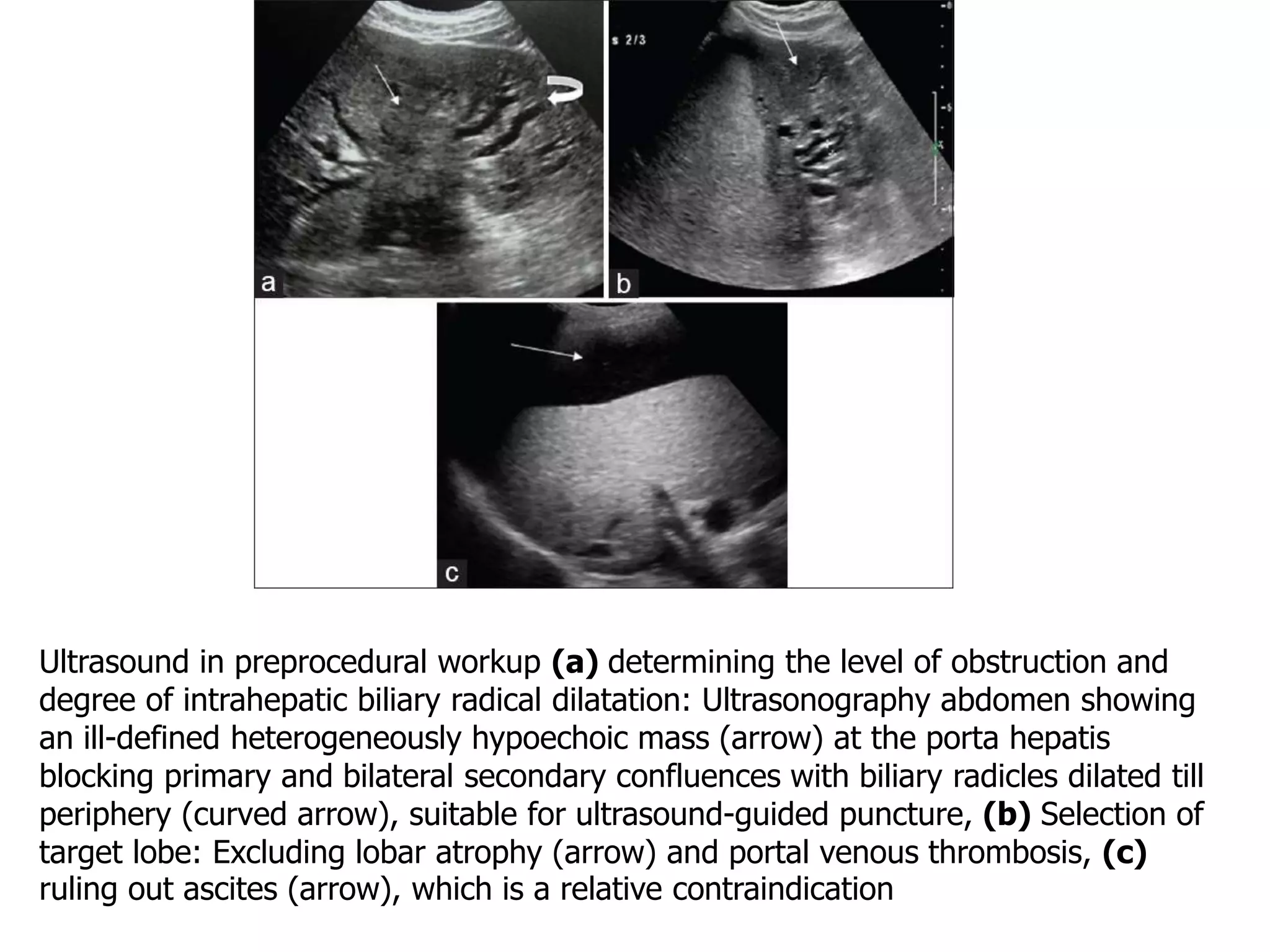 Biliary drainage | PPTX