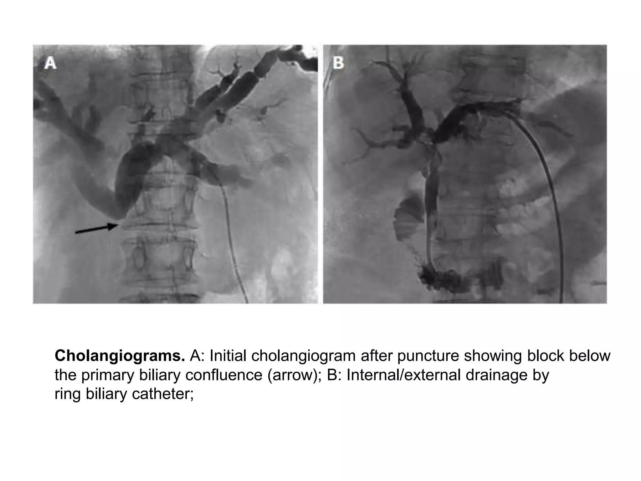 Biliary drainage | PPTX