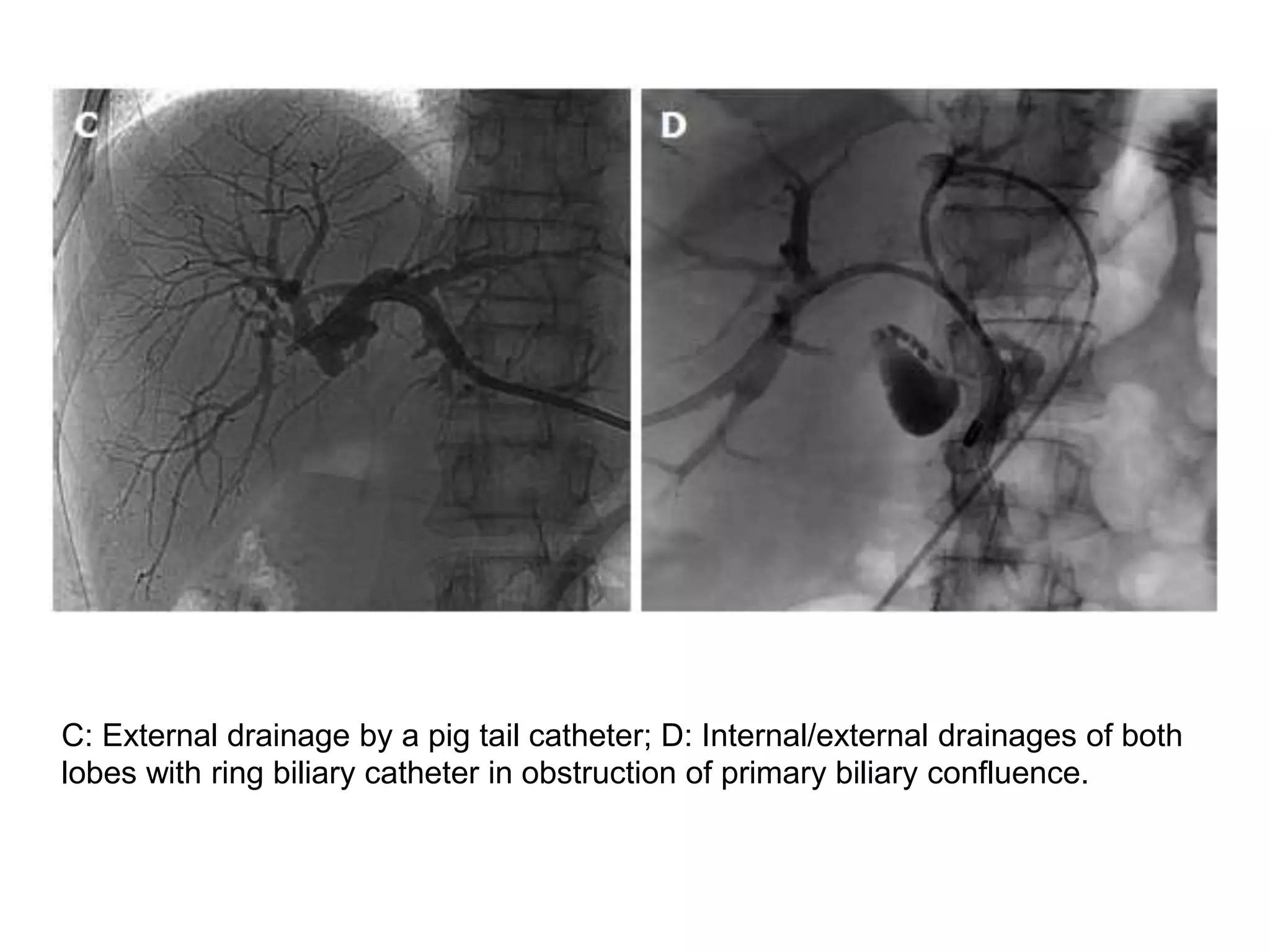 Biliary drainage | PPTX