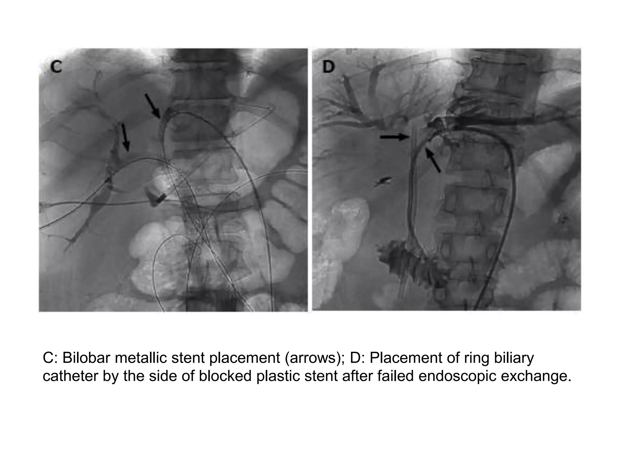 Biliary drainage | PPTX