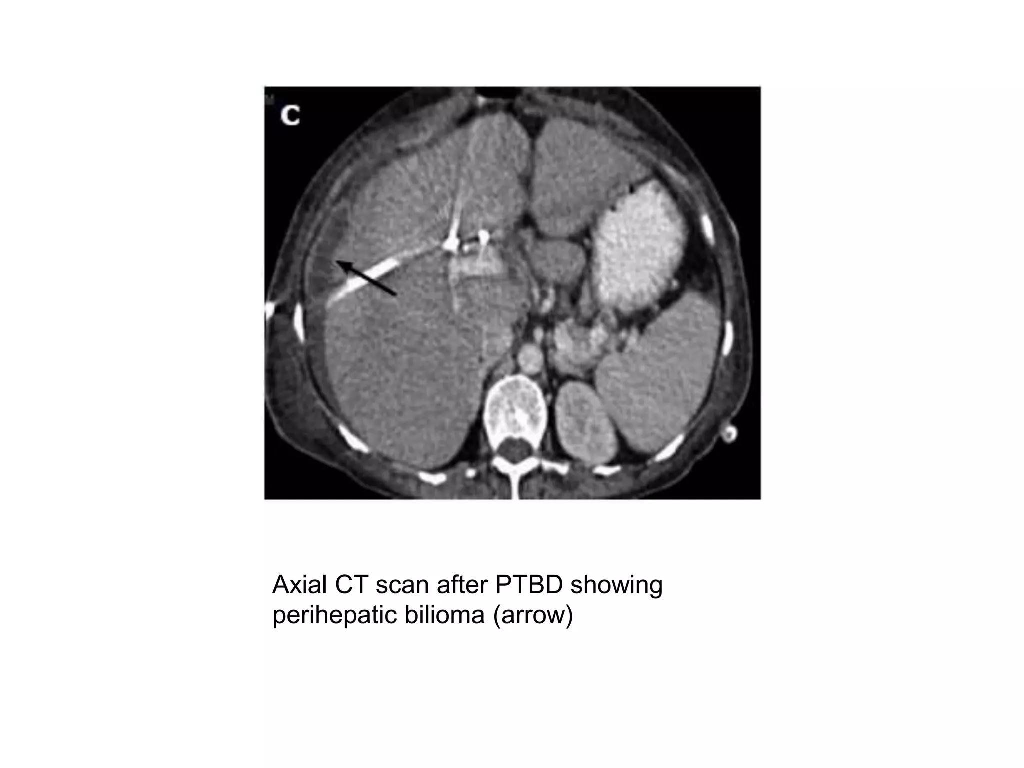 Biliary drainage | PPTX