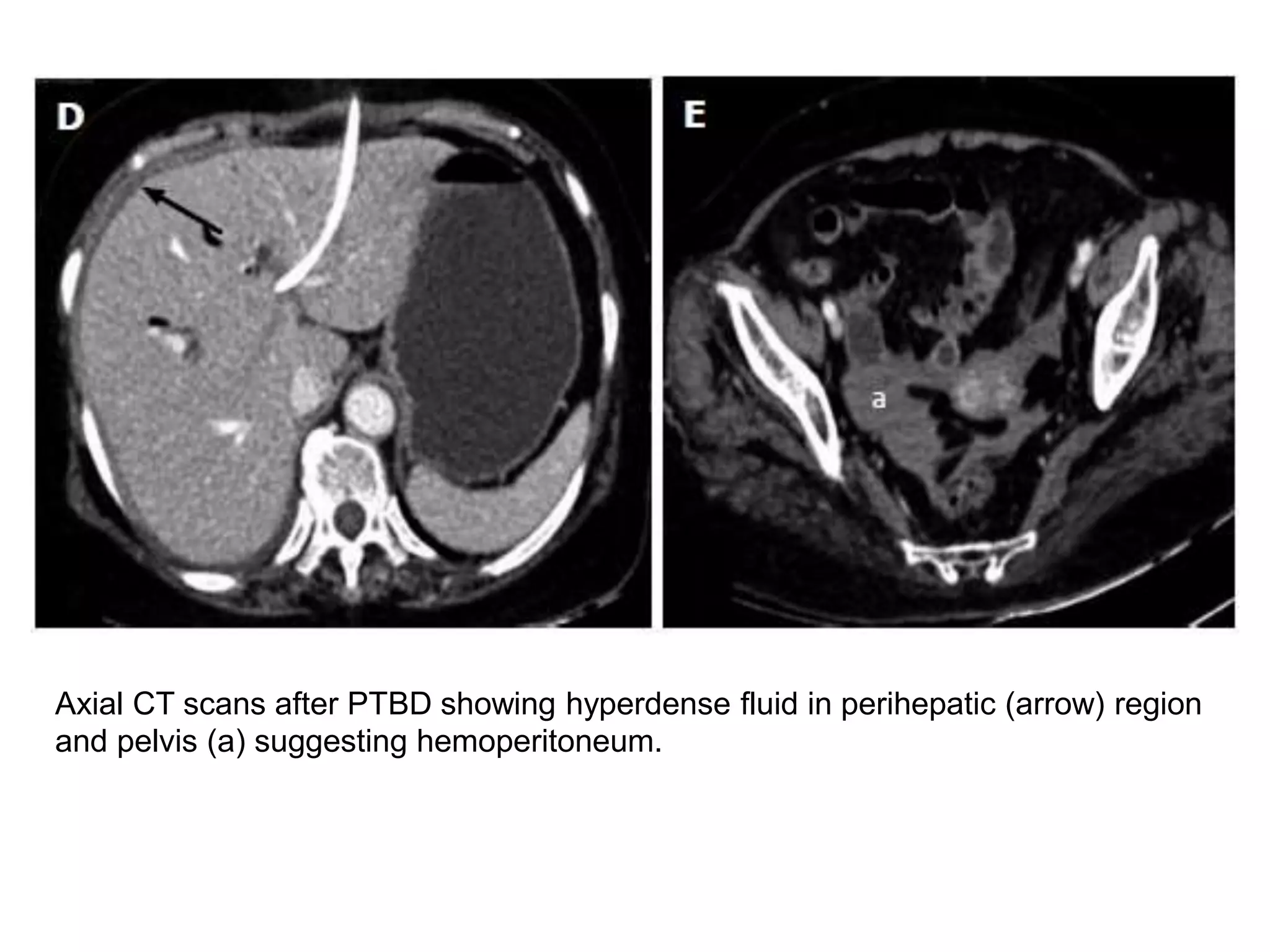 Biliary drainage | PPTX