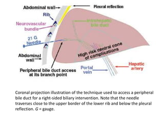 Biliary drainage | PPTX | Digestive Disorders | Diseases and Conditions