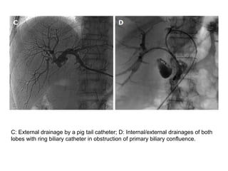 Biliary drainage | PPTX