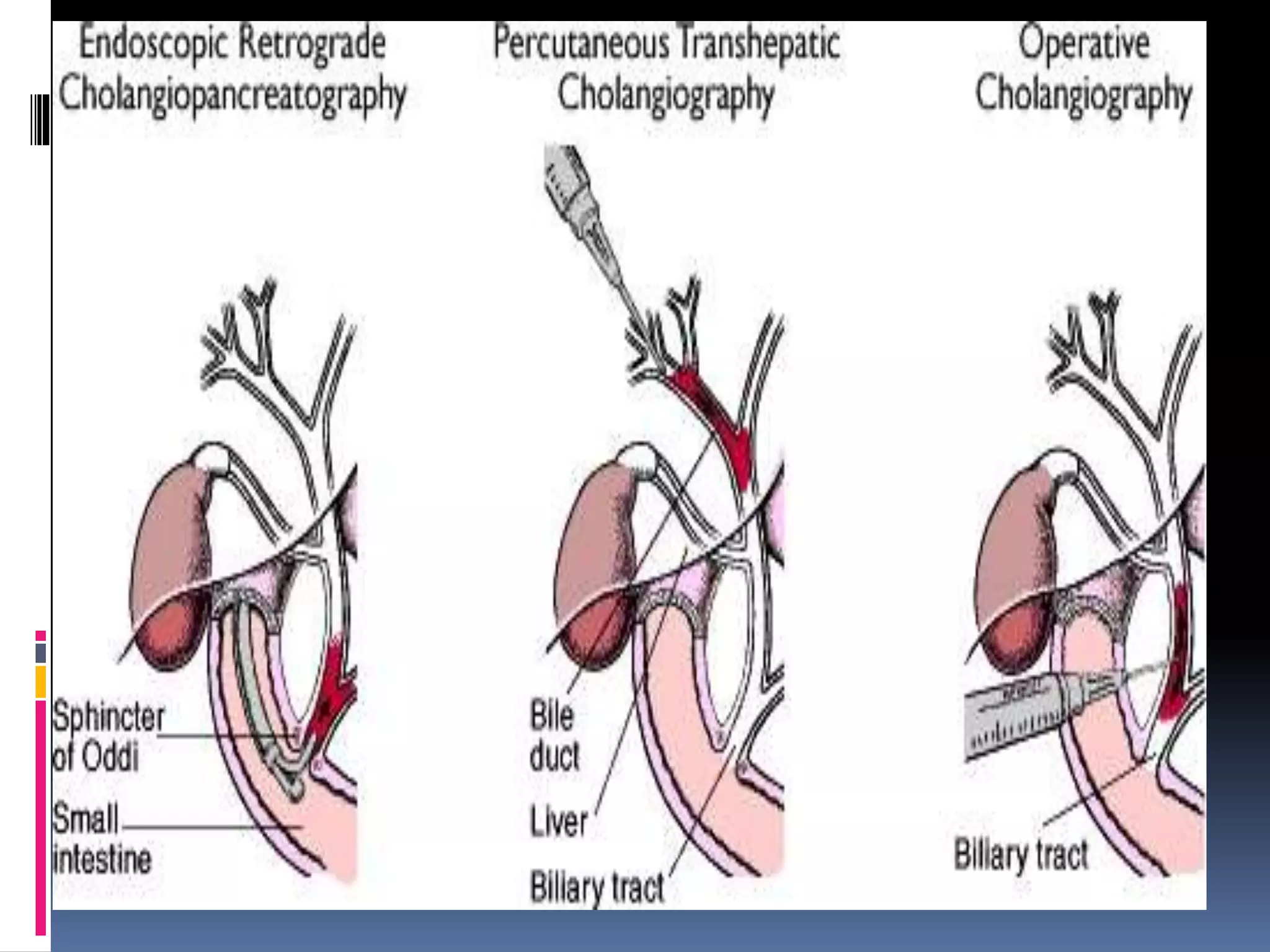 Biliary stricture ppt | PPTX