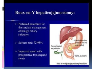 Roux En Y Choledochojejunostomy