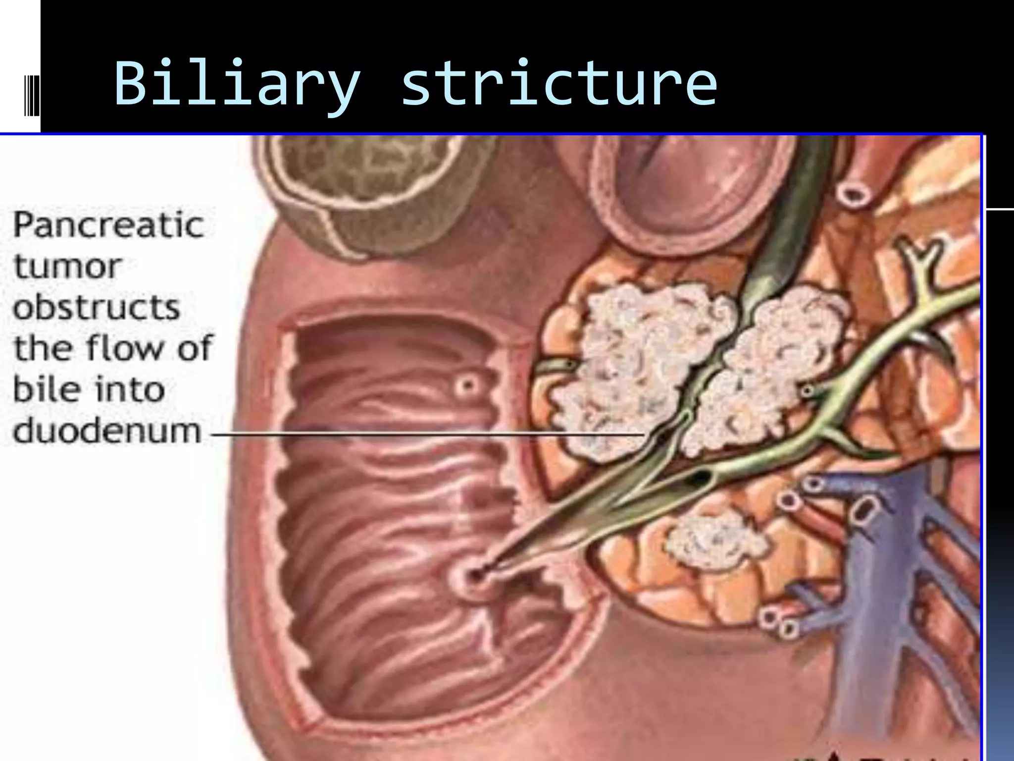 biliary strictures | PPTX