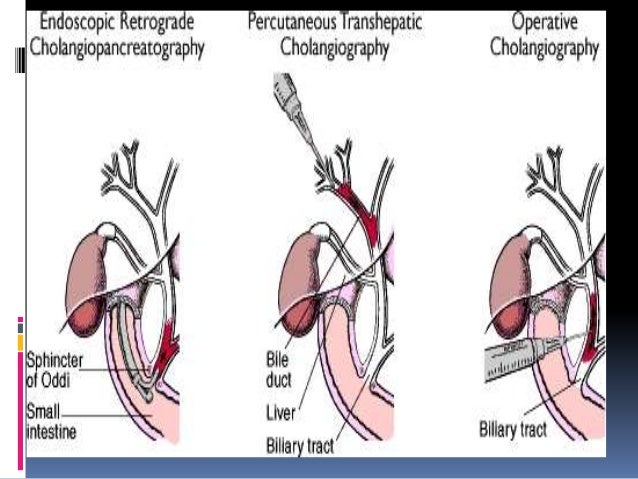 biliary strictures