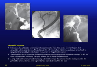 Biliary strictures | PDF
