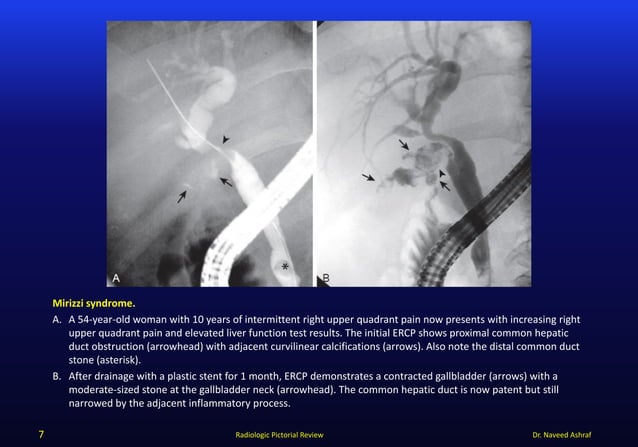 Biliary strictures | PDF | Digestive Disorders | Diseases and Conditions