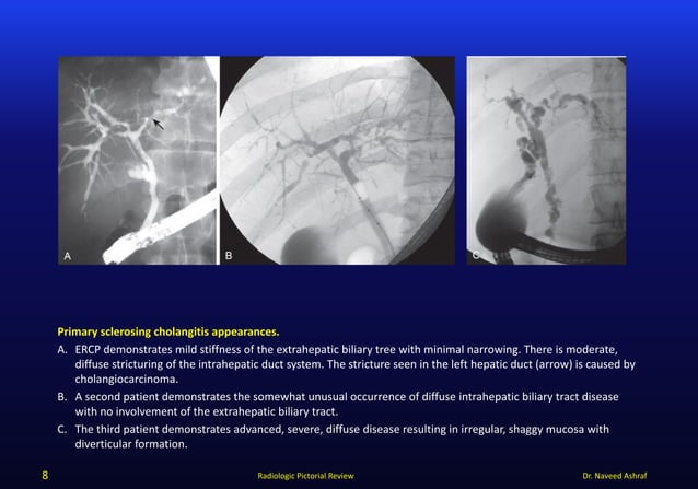 Biliary strictures | PDF | Digestive Disorders | Diseases and Conditions