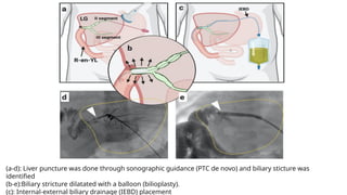 CAUSES OF BILIARY STRICTURES AND ITS MANAGEMENT | PPTX