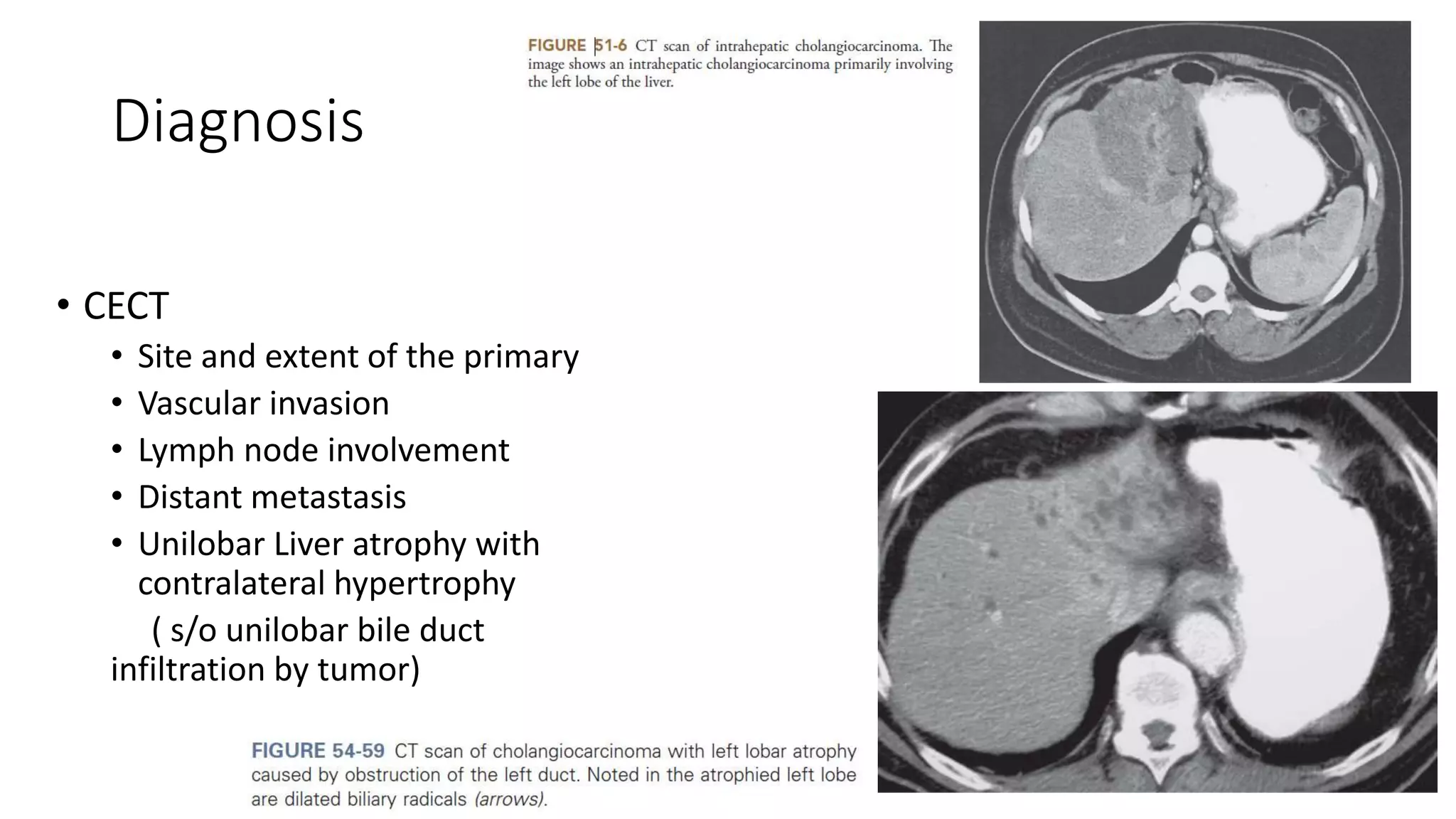 Biliary tract cancer | PPTX
