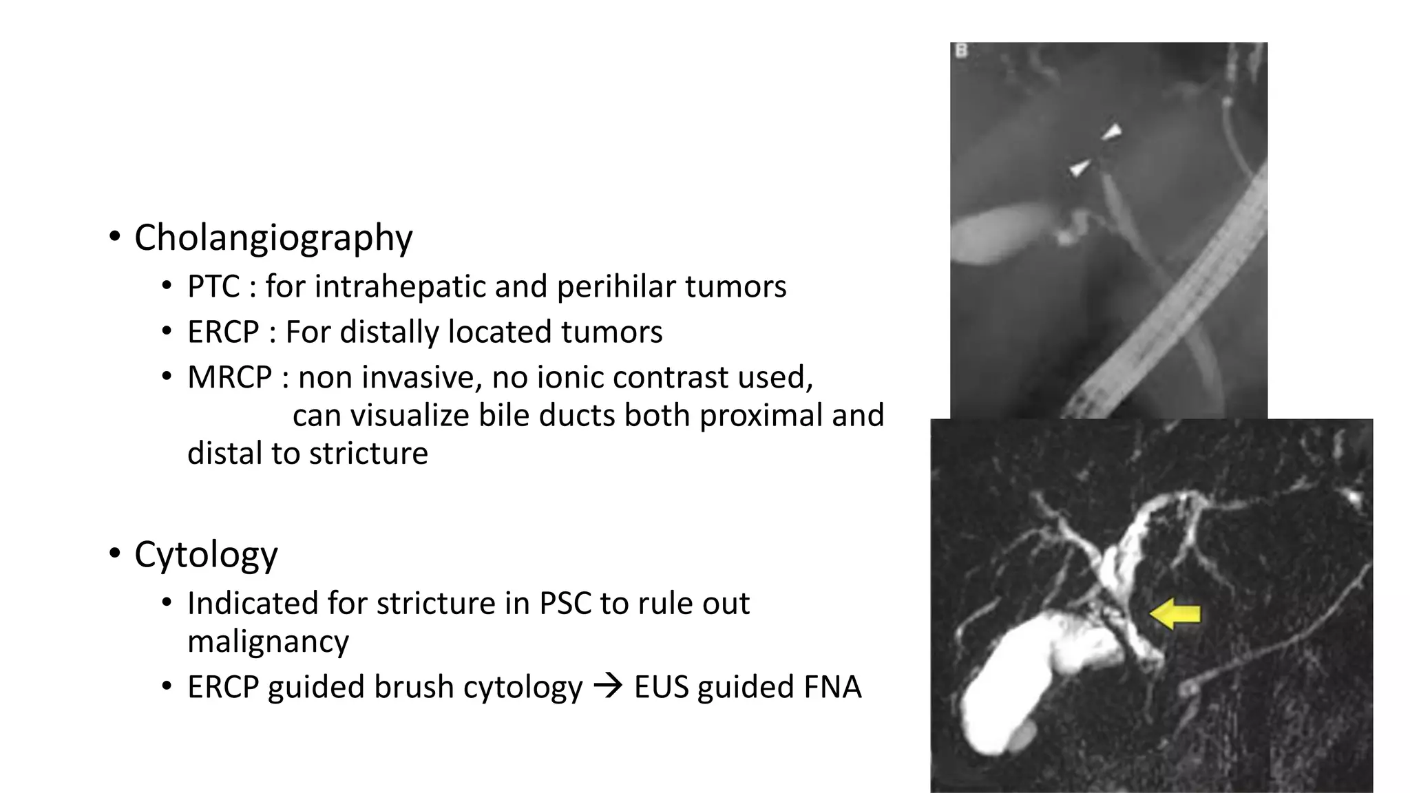 Biliary tract cancer | PPTX