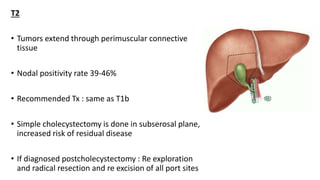 Biliary tract cancer | PPTX
