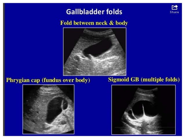 Biliary tract imaging final........... | PPTX | Digestive Disorders | Diseases and Conditions