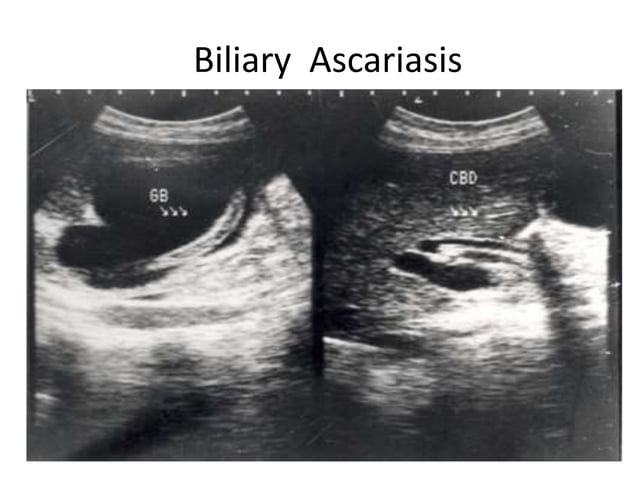 Biliary tract imaging final........... | PPTX | Digestive Disorders ...
