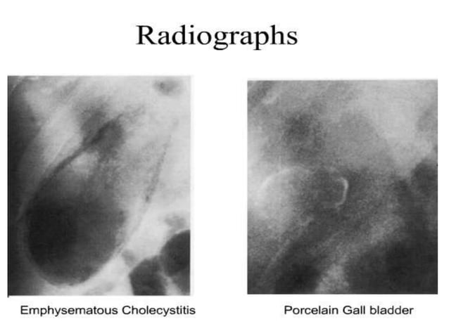Biliary tract imaging final........... | PPTX | Digestive Disorders ...
