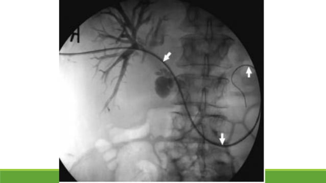 Biliary tract interventions | PDF