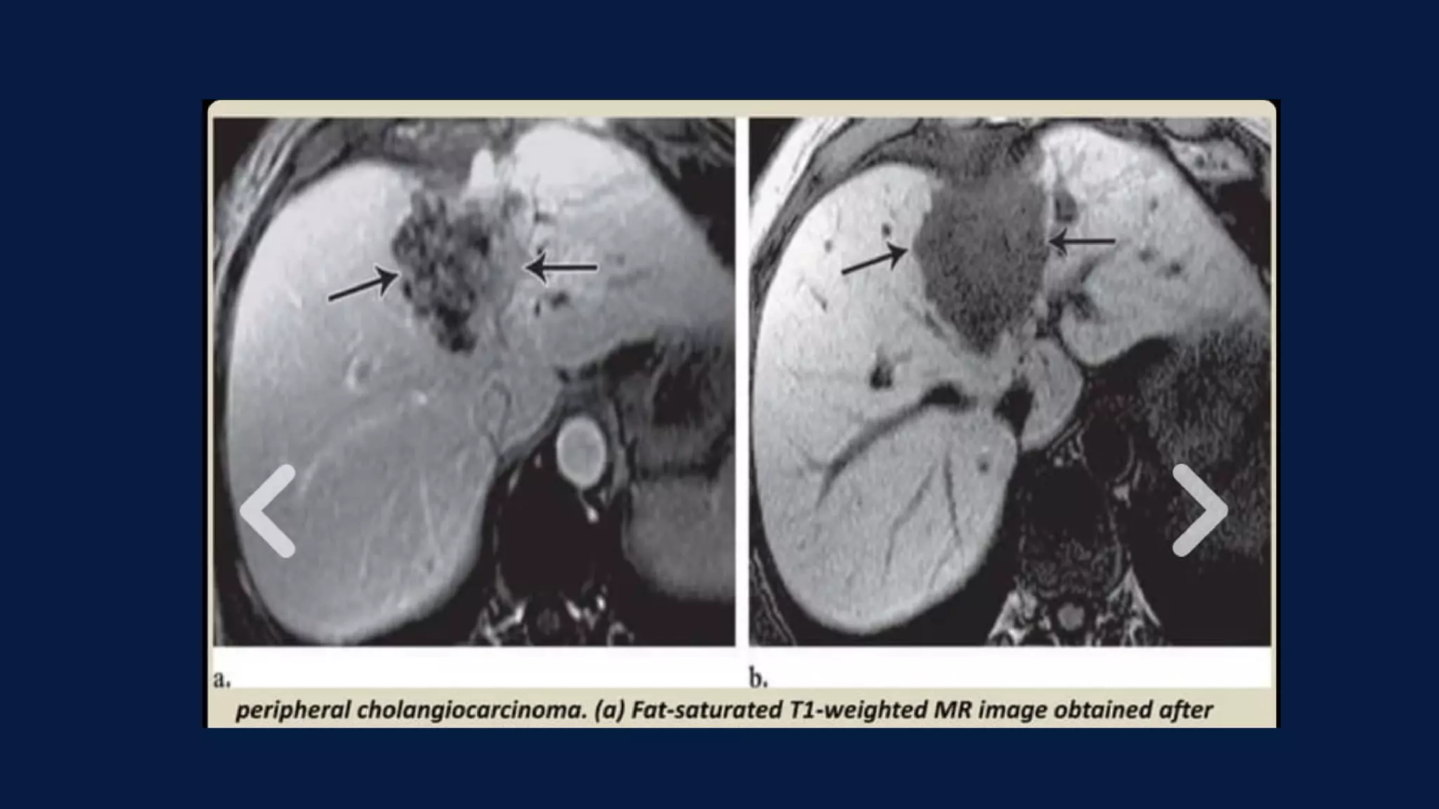Biliary Tract Tumours(Cholangiocarcinoma,Cystadenoma/cystadenocarcinoma ...