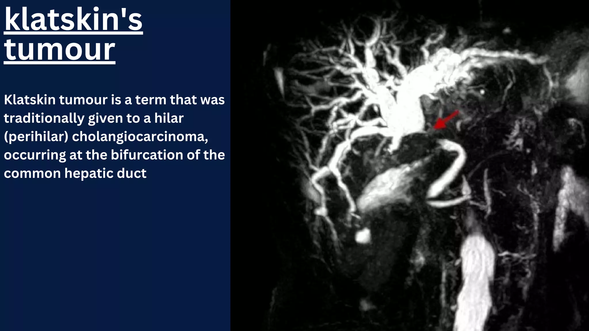 Biliary Tract Tumours Cholangiocarcinoma Cystadenoma Cystadenocarcinoma