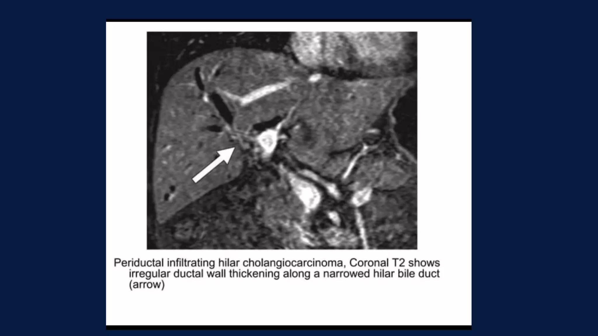 Biliary Tract Tumours(Cholangiocarcinoma,Cystadenoma/cystadenocarcinoma ...