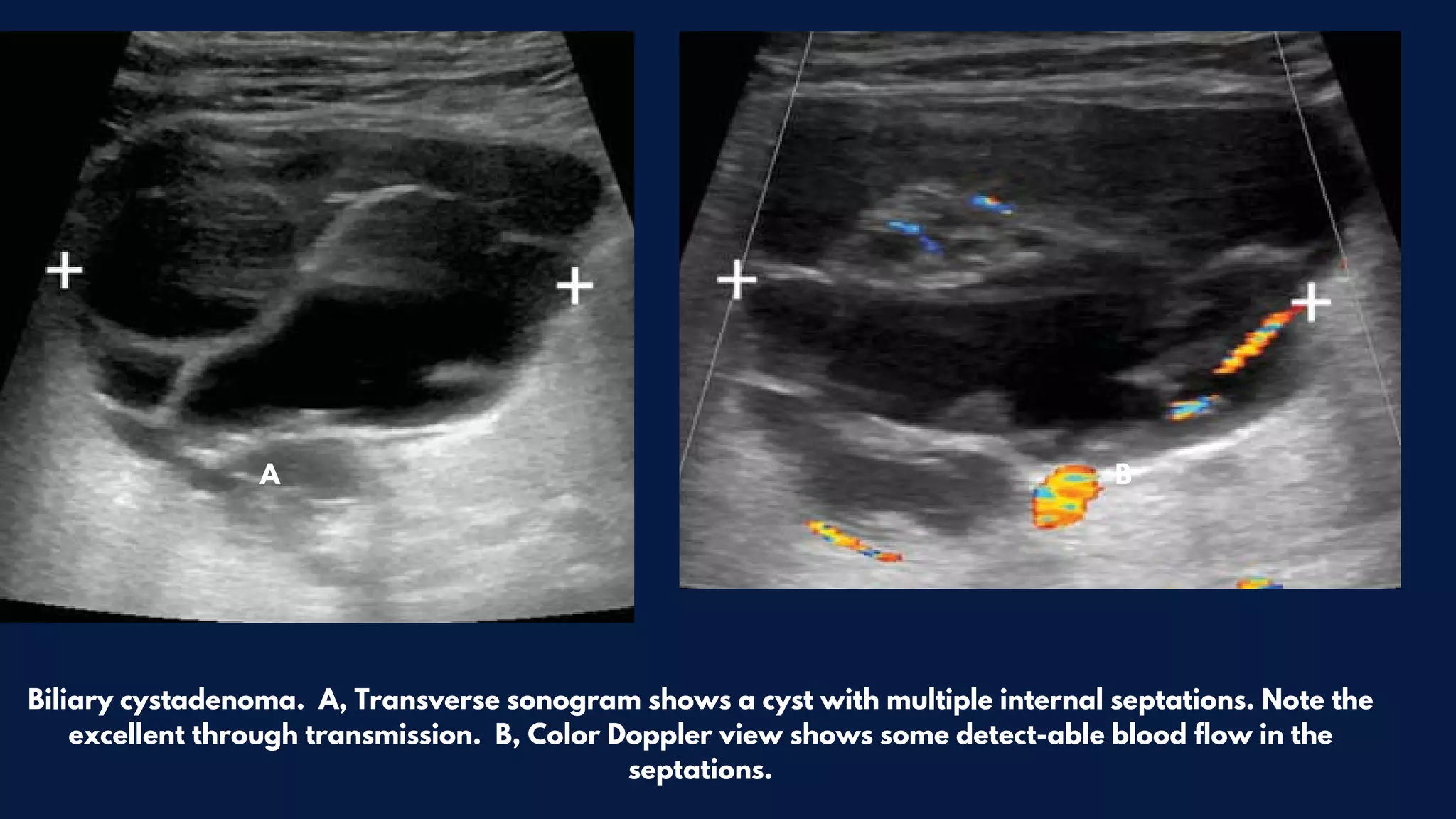 Biliary Tract Tumours(Cholangiocarcinoma,Cystadenoma/cystadenocarcinoma ...