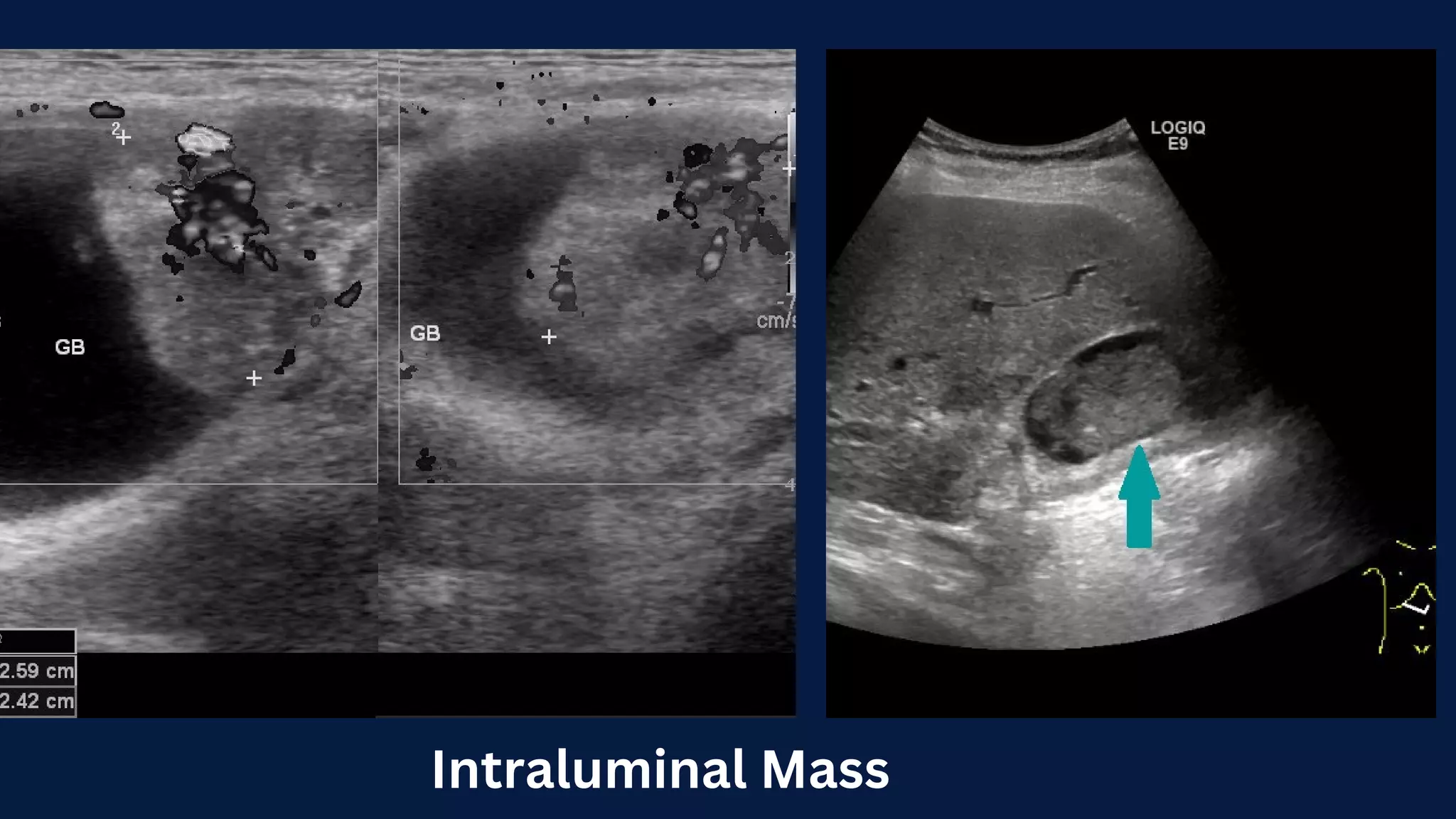 Biliary Tract Tumours(Cholangiocarcinoma,Cystadenoma/cystadenocarcinoma ...