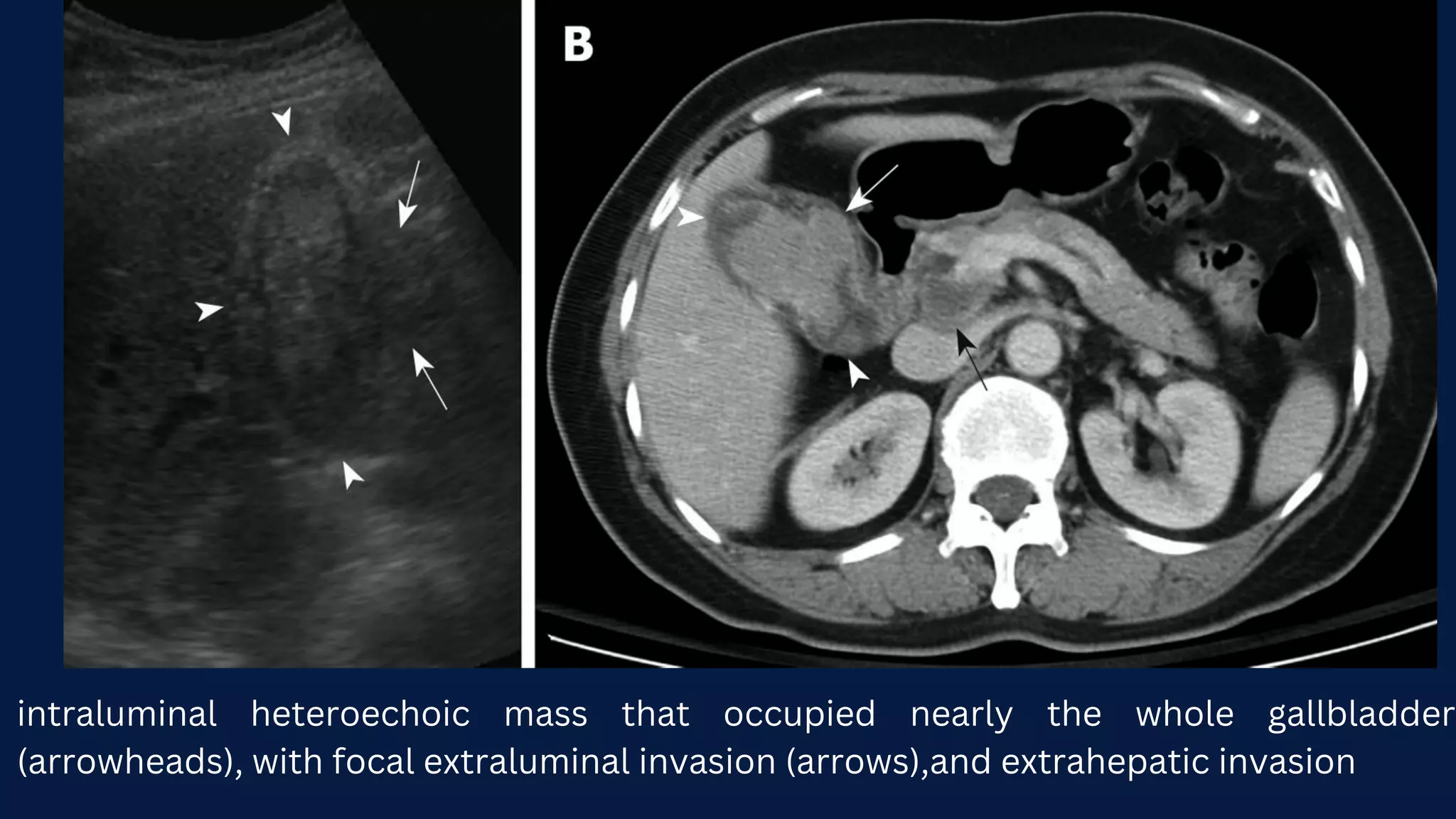 Biliary Tract Tumours(Cholangiocarcinoma,Cystadenoma/cystadenocarcinoma ...