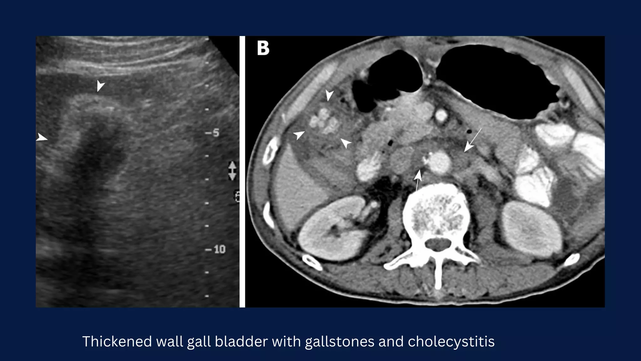 Biliary Tract Tumours(Cholangiocarcinoma,Cystadenoma/cystadenocarcinoma ...