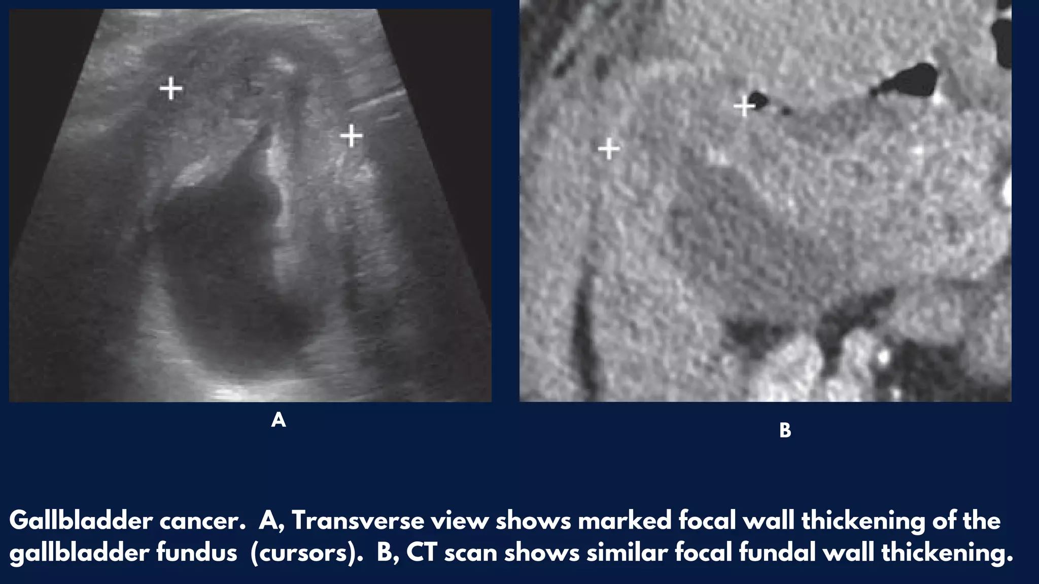 Biliary Tract Tumours(Cholangiocarcinoma,Cystadenoma/cystadenocarcinoma ...