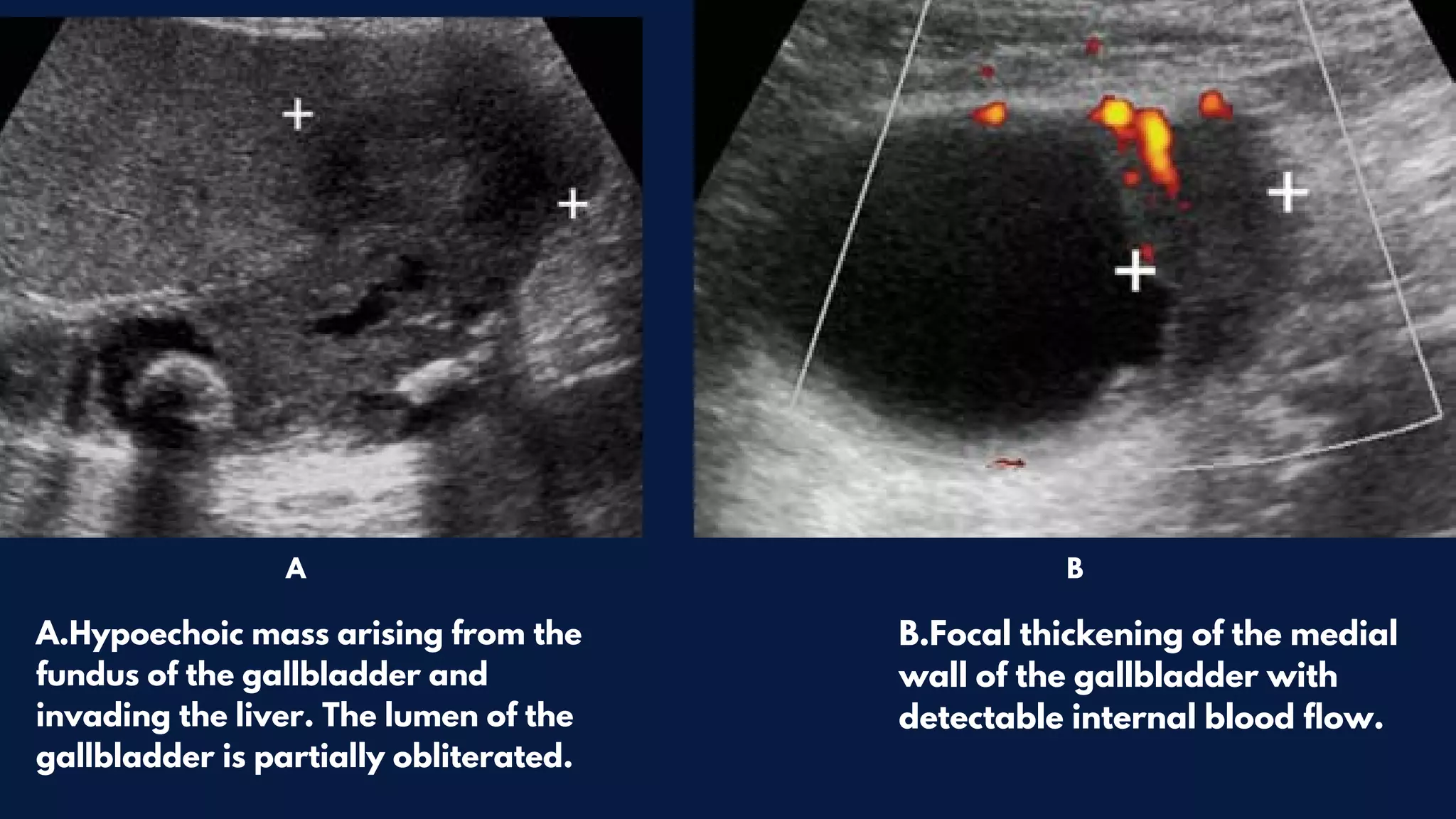 Biliary Tract Tumours(Cholangiocarcinoma,Cystadenoma/cystadenocarcinoma ...