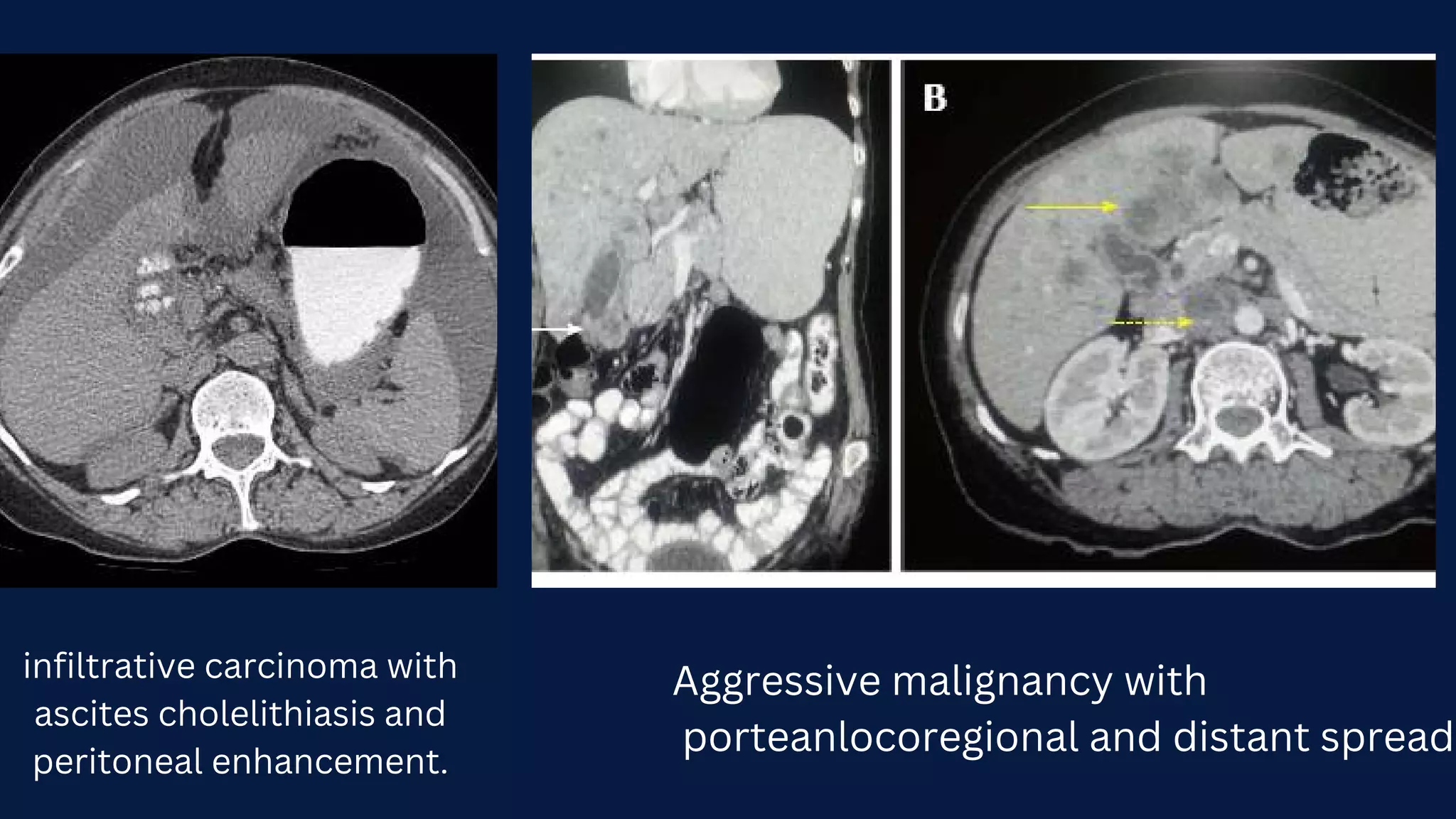 Biliary Tract Tumours(Cholangiocarcinoma,Cystadenoma/cystadenocarcinoma ...