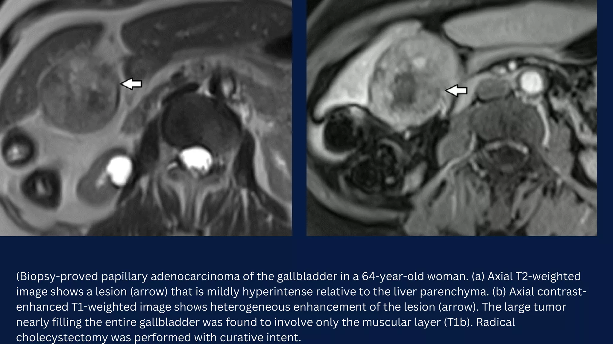Biliary Tract Tumours(Cholangiocarcinoma,Cystadenoma/cystadenocarcinoma ...