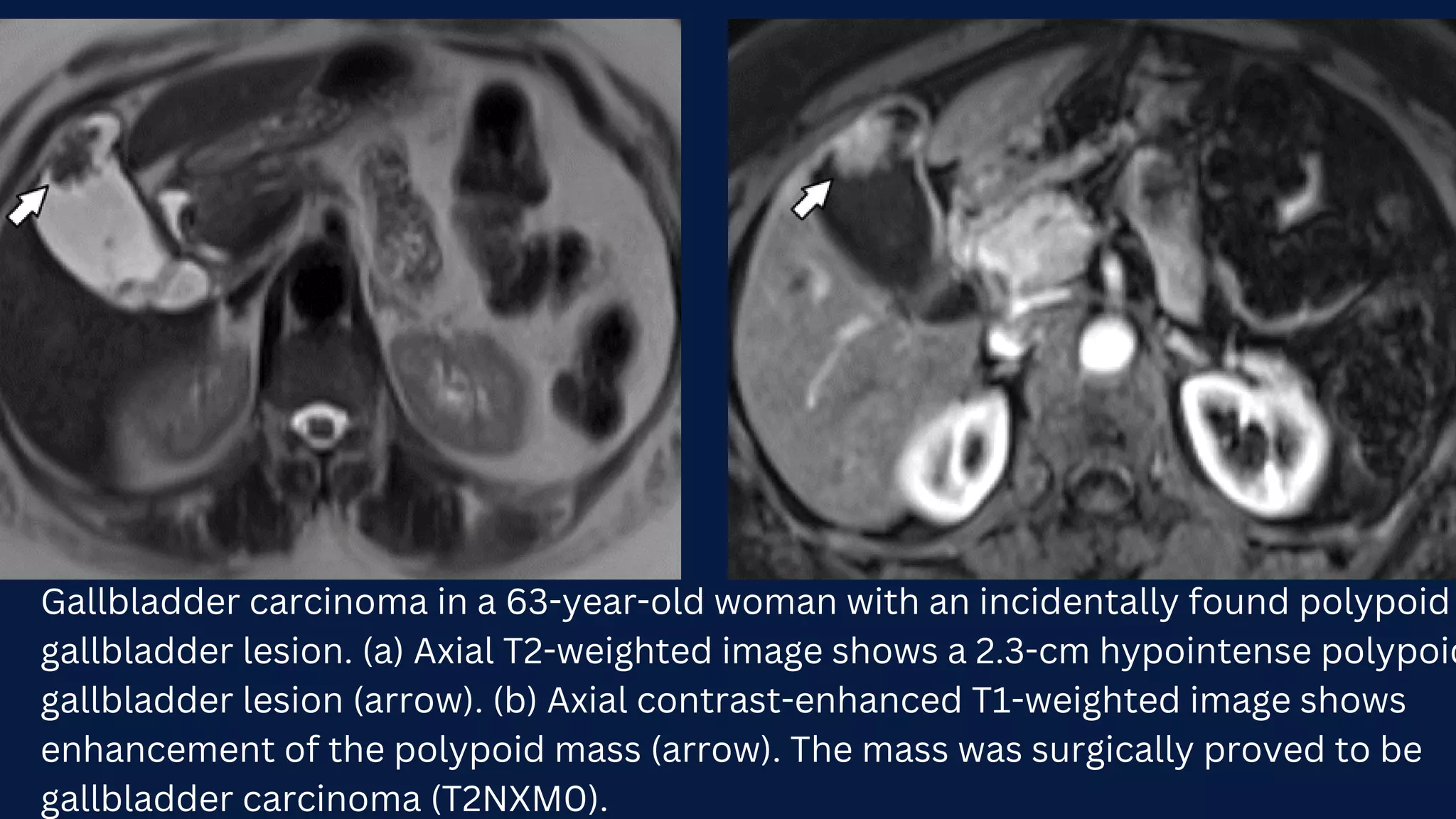 Biliary Tract Tumours(Cholangiocarcinoma,Cystadenoma/cystadenocarcinoma ...