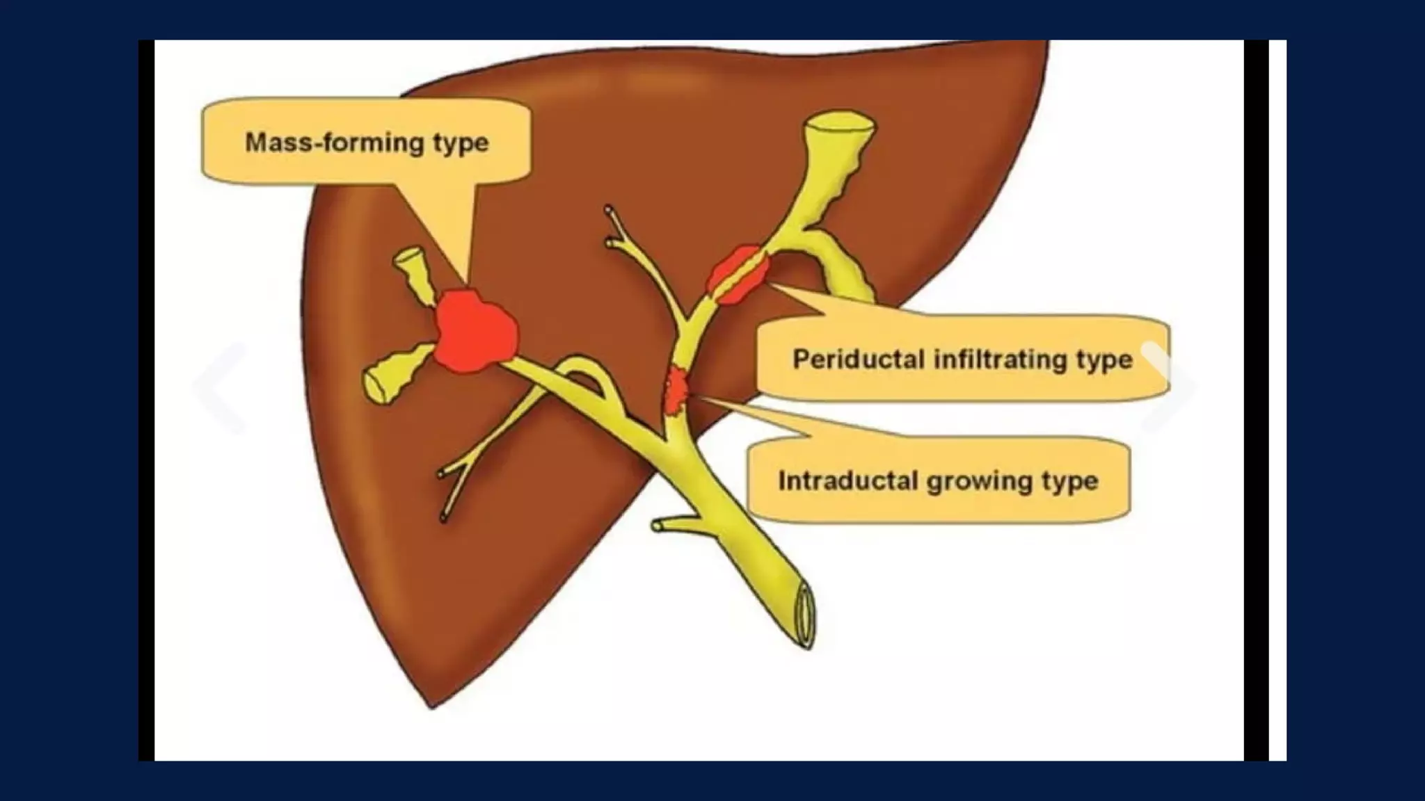 Biliary Tract Tumours(Cholangiocarcinoma,Cystadenoma/cystadenocarcinoma ...