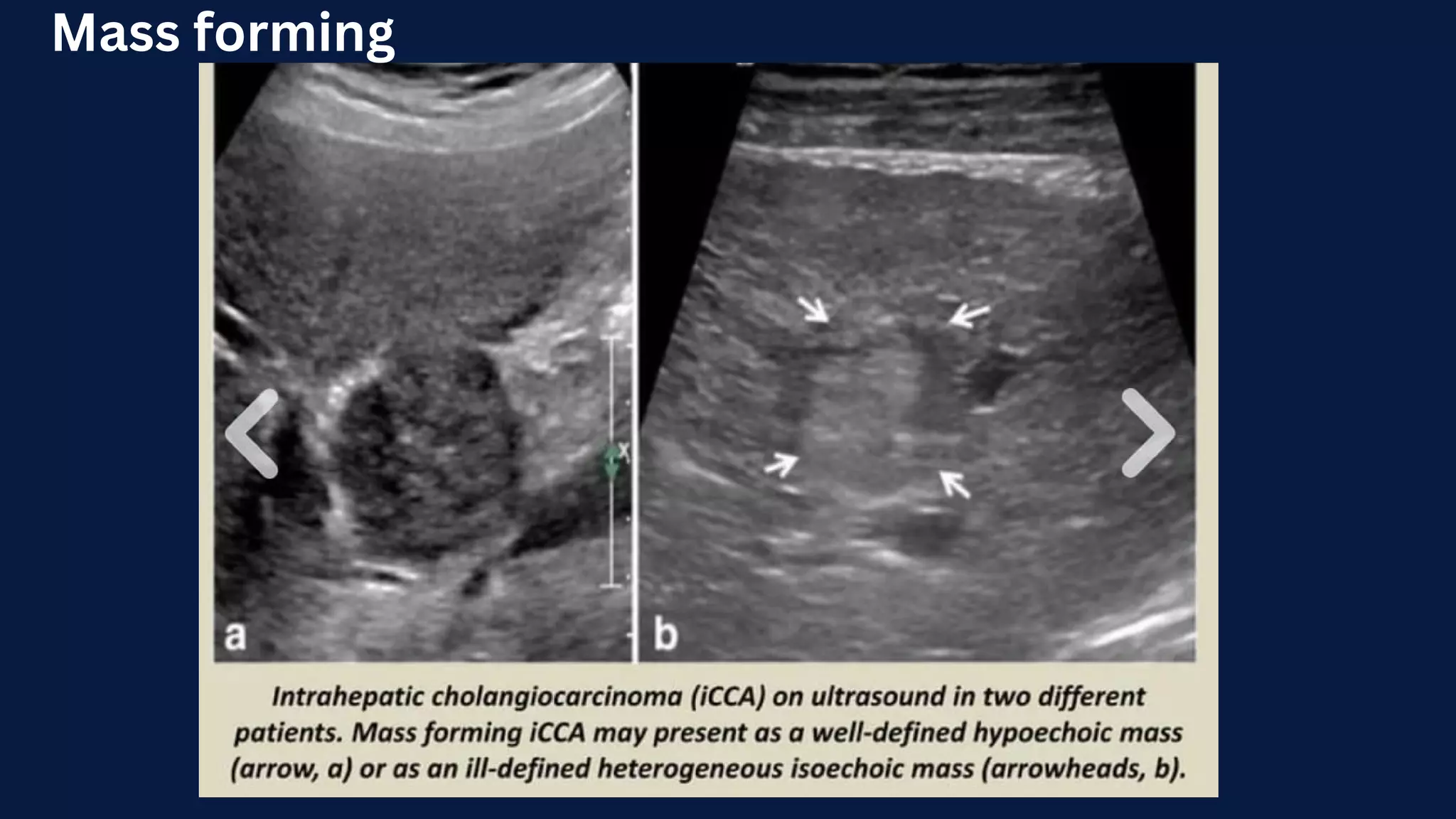 Biliary Tract Tumours(Cholangiocarcinoma,Cystadenoma/cystadenocarcinoma ...