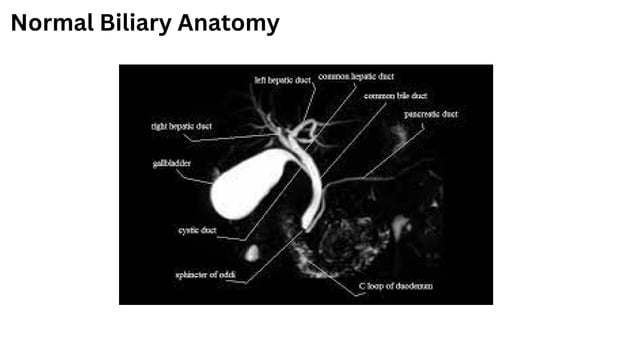 Biliary Tract Tumours(Cholangiocarcinoma,Cystadenoma/cystadenocarcinoma ...