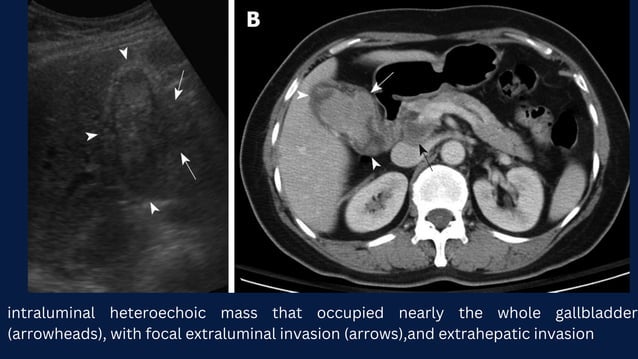 Biliary Tract Tumours(Cholangiocarcinoma,Cystadenoma/cystadenocarcinoma ...