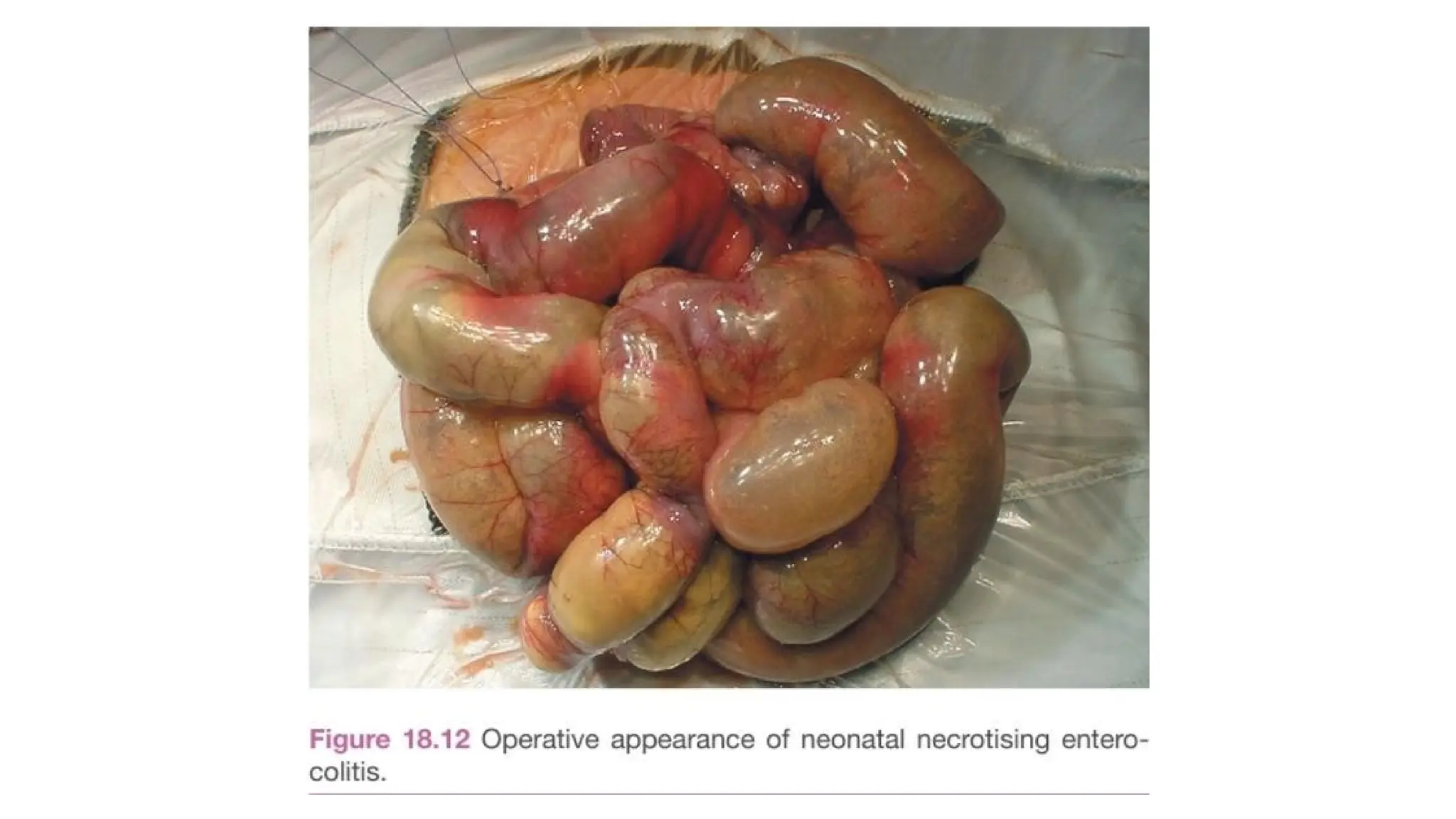 congenital and adult BILIOUS VOMITING.pptx