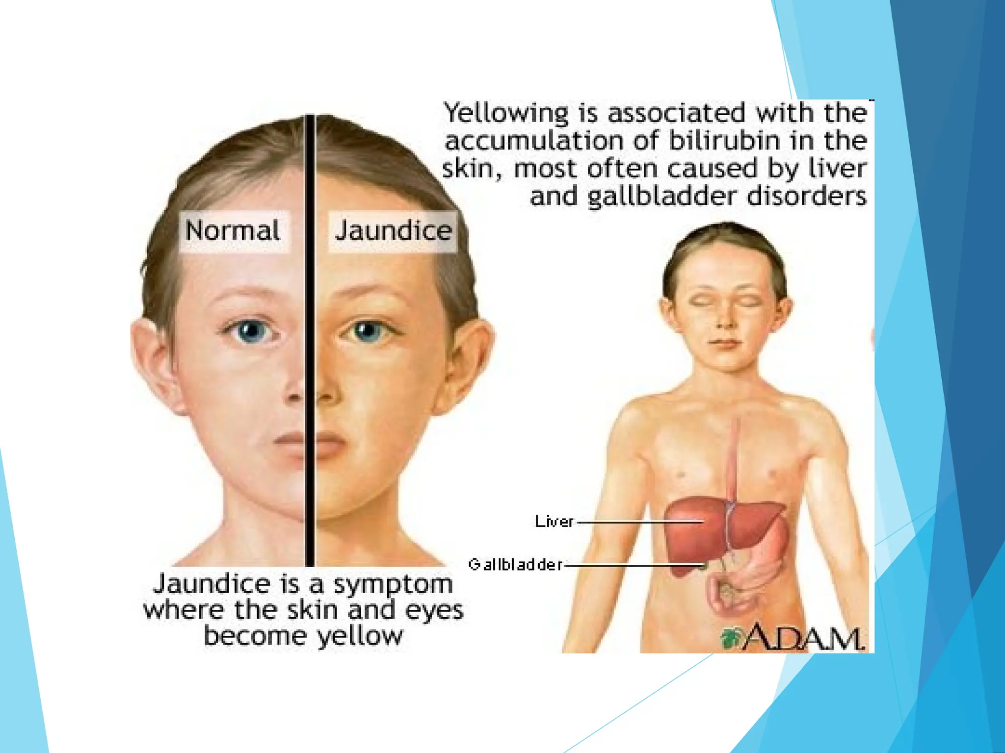 BILIRUBIN MEABOLISM & JAUNDICE and liver failure | PPT