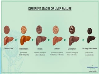 BILIRUBIN MEABOLISM & JAUNDICE and liver failure | PPT