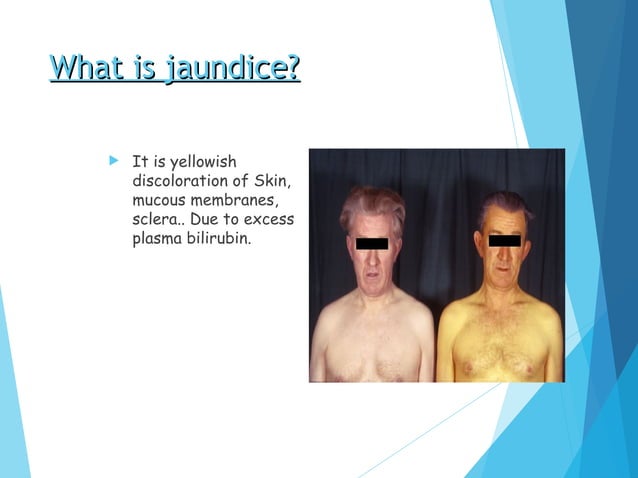 BILIRUBIN MEABOLISM & JAUNDICE and liver failure | PPT