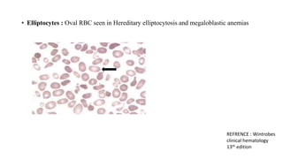 Bilirubin metabolism, Hemolytic anemia-classification and lab diagnosis ...
