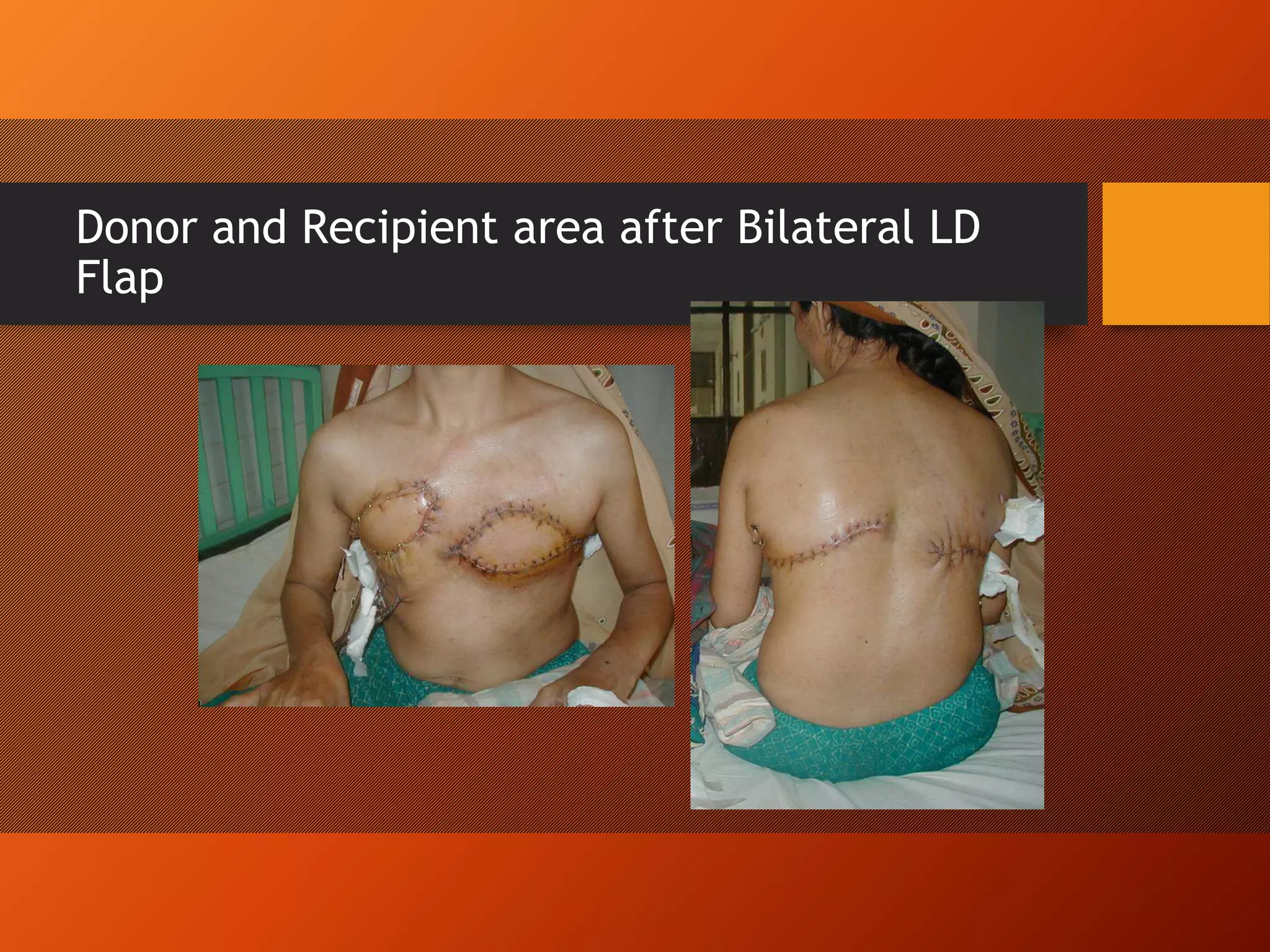 Bilateral Lat Dorsi Flap.pptx | Cancer | Diseases and Conditions