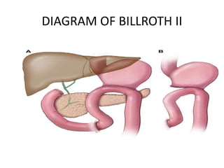 BILLROTH SURGICALPROCEDURE PRESENTATION.pptx