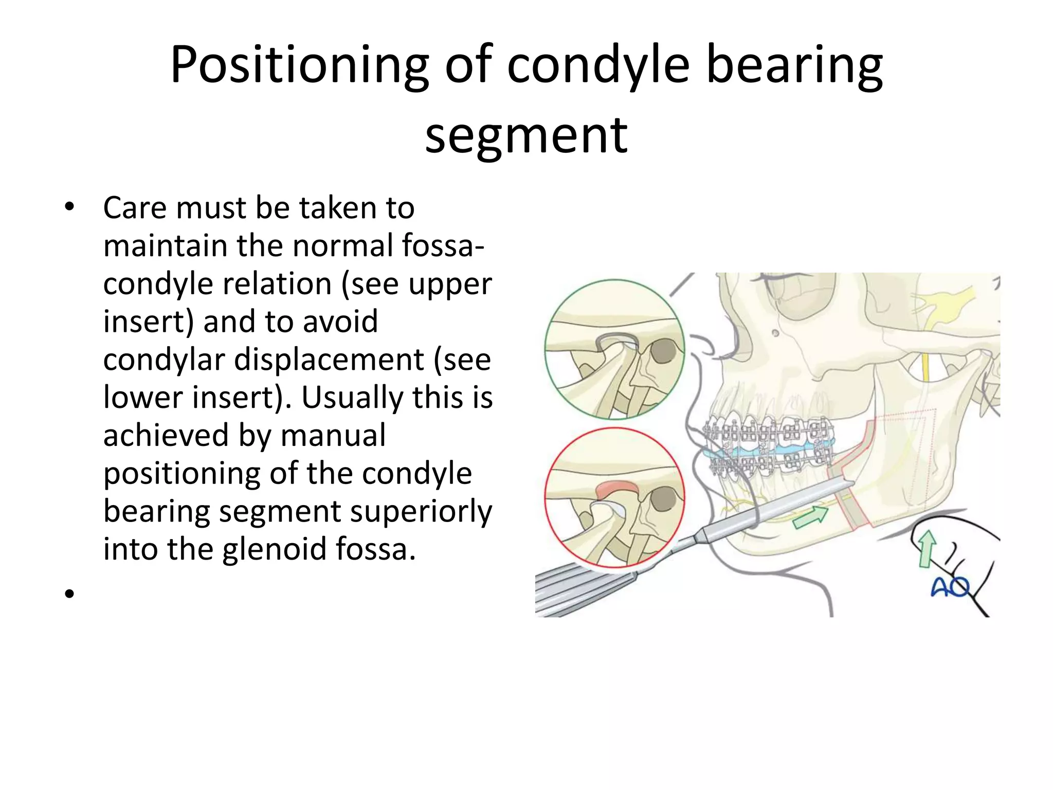 Bilteral sagittal split osteotomy | PPTX