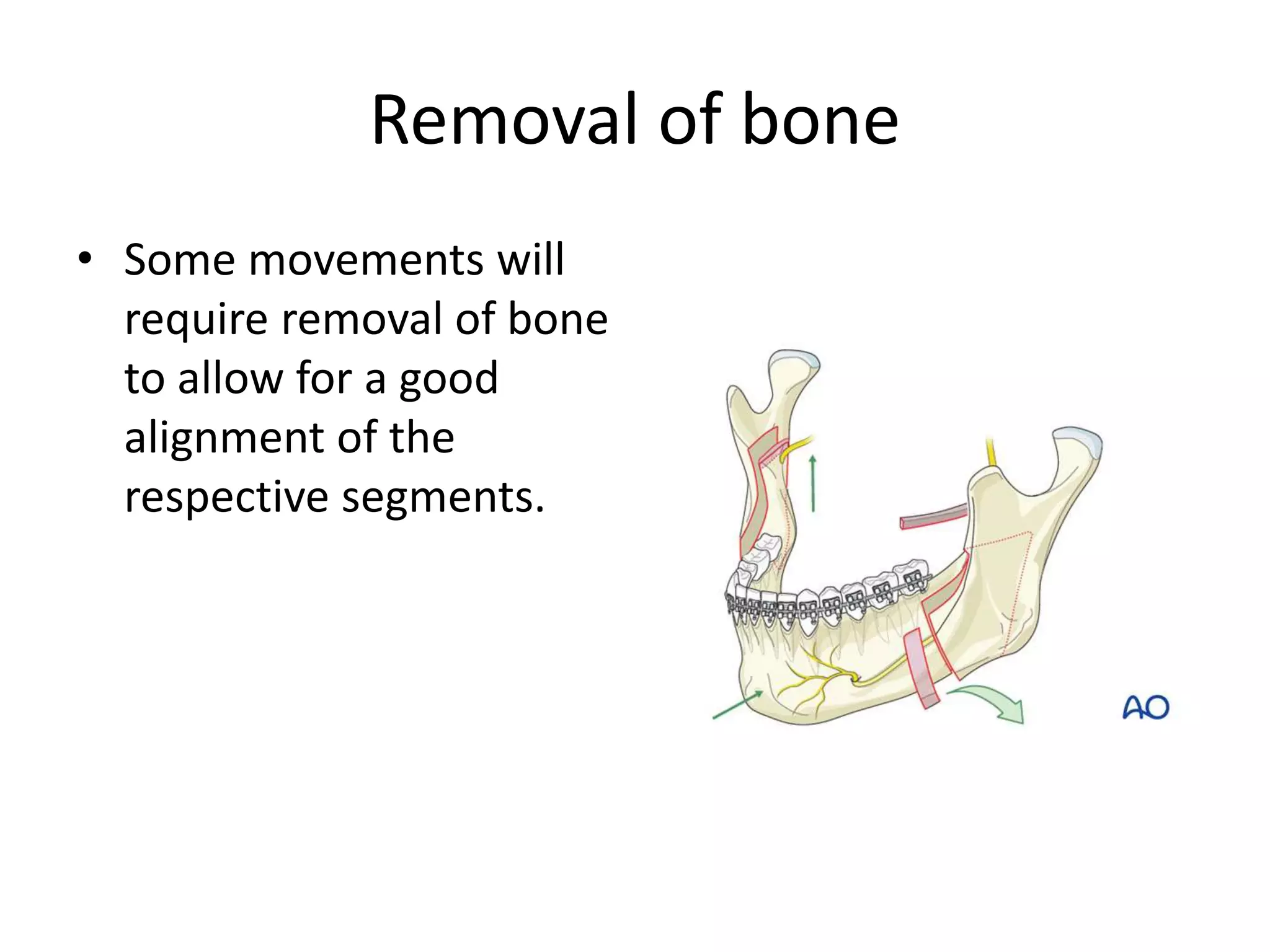 Bilteral sagittal split osteotomy | PPTX