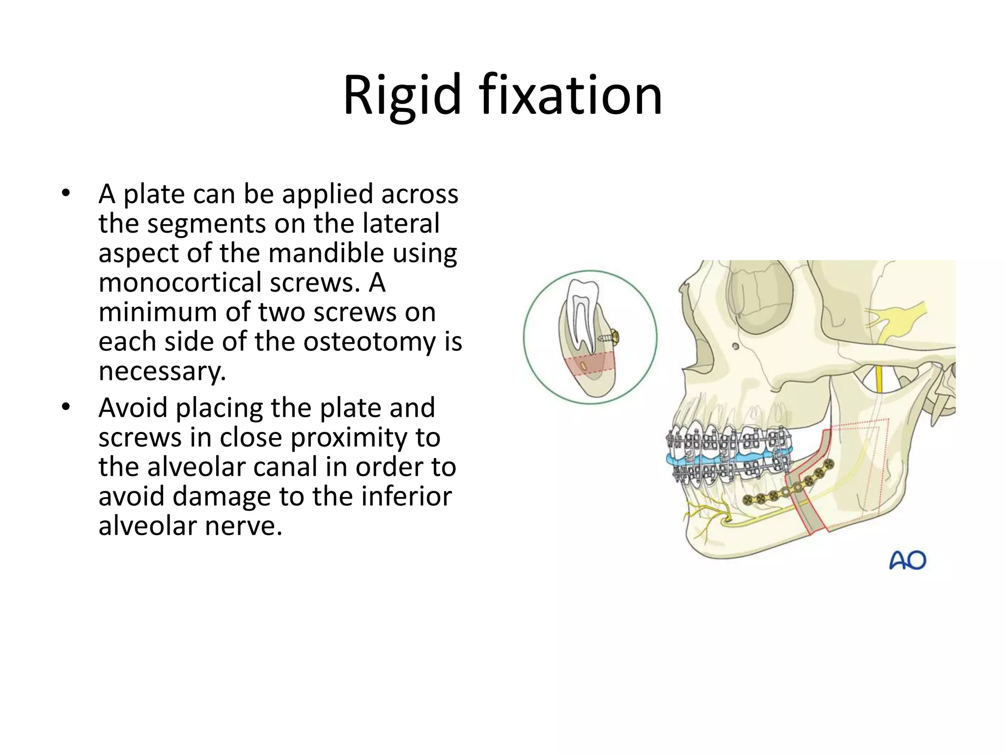 Bilteral sagittal split osteotomy | PPTX