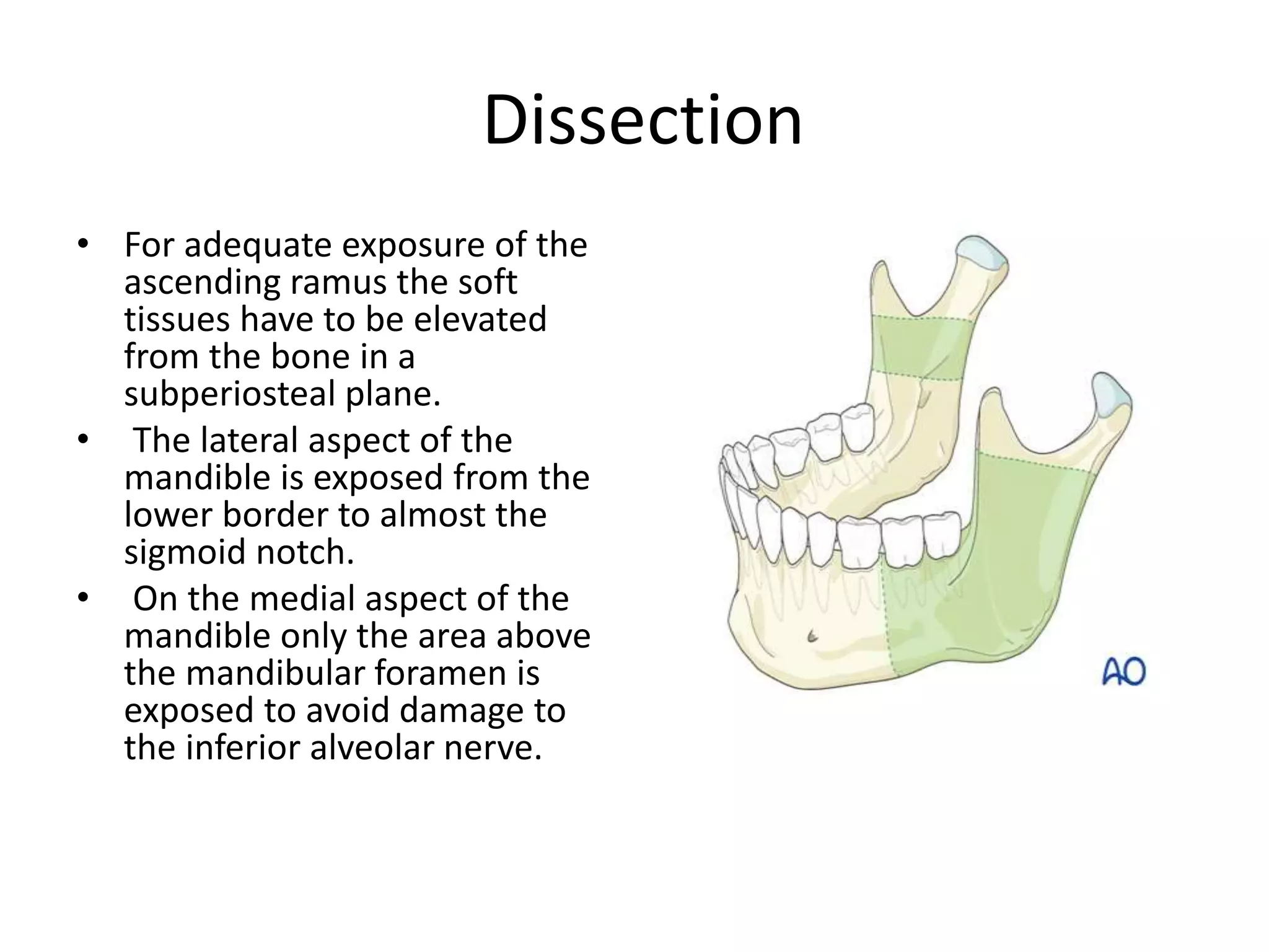 Bilteral sagittal split osteotomy | PPTX